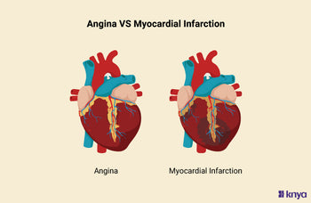 Angina vs Myocardial Infarction | Key Differences – Knya
