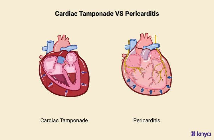 Differences Between Cardiac Tamponade and Pericarditis – Knya
