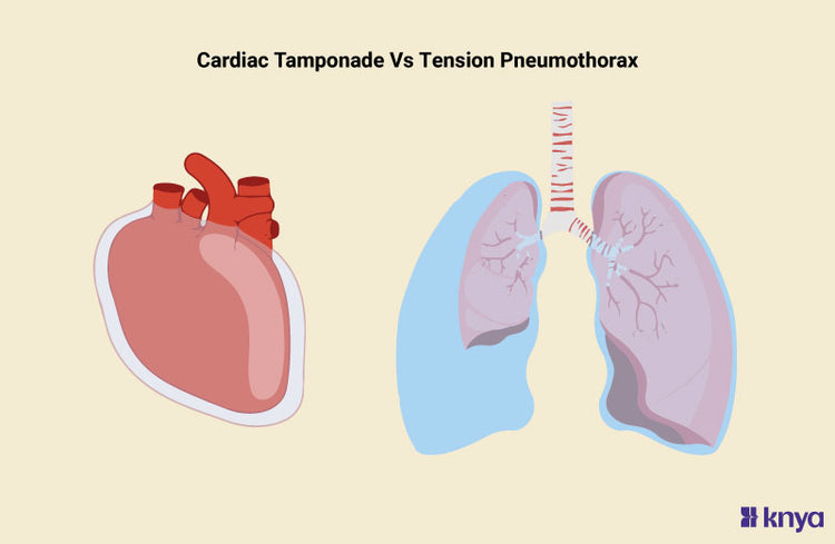 Difference Between Cardiac Tamponade Vs Tension Pneumothorax! – Knya