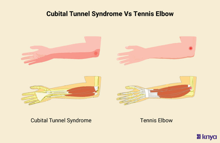 Cubital Tunnel vs. Tennis Elbow: Features, Similarities & Differences ...