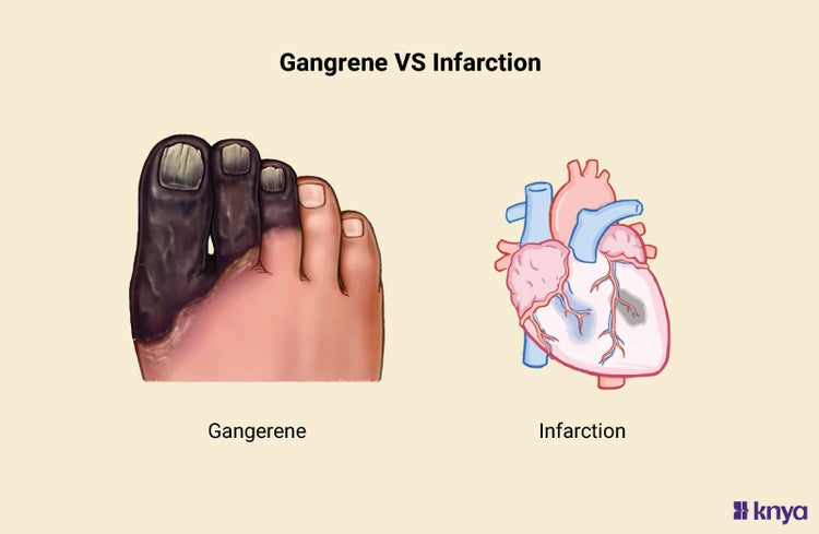 Difference Between Gangrene and Infarction – Knya