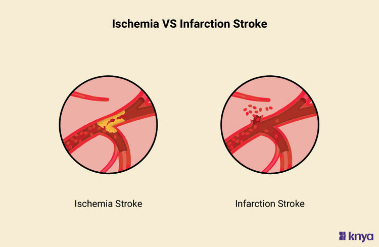 Ischemia vs Infarction Stroke | Understand the differences! – Knya