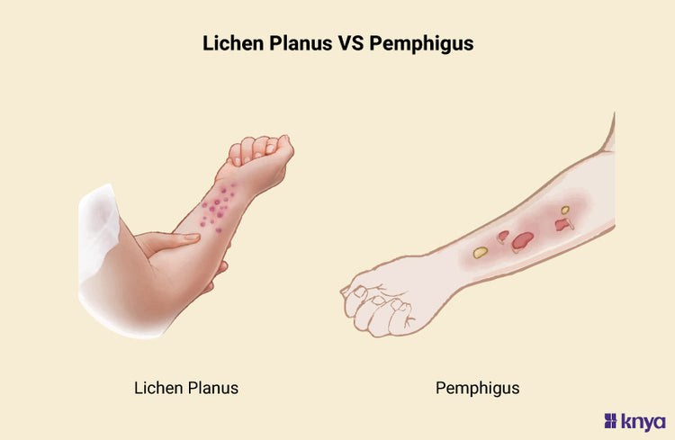 Decoding Dermatological Disorders: Lichen Planus vs. Pemphigus – Knya