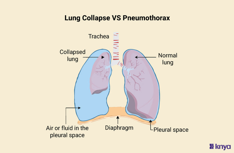 Lung collapse vs Pneumothorax | Unzip the differences! – Knya