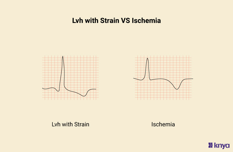 LVH with Strain and Ischemia, Know about Electrocardiographic Pattern ...