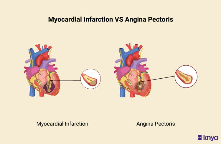 Angina Pectoris Vs Myocardial Infarction | Key Differences – Knya