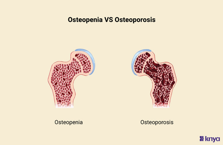 Osteopenia Vs osteoporosis | Understand the Differences – Knya