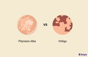 Pityriasis Alba Vs Vitiligo: Check Difference and Similarities – Knya