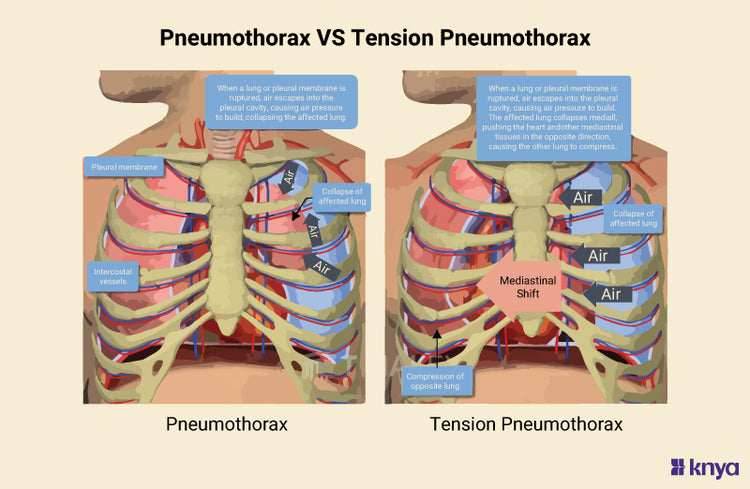 Pneumothorax vs Tension Pneumothorax | Collapsed Lung vs. Emergency – Knya