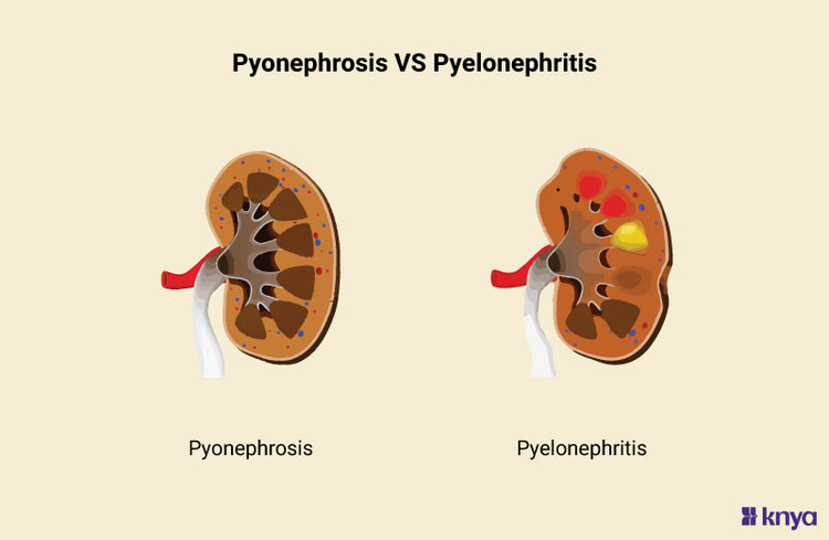 Pyonephrosis vs Pyelonephritis | Don't Let Kidney Infections Puzzle You! – Knya