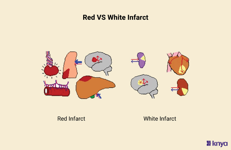 Differences Between Red and White Infarcts – Knya