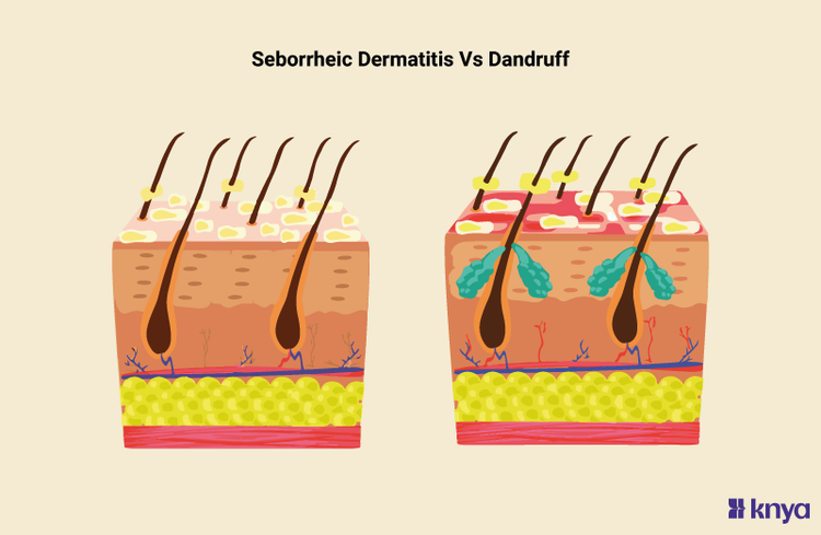 Scalp Flakes: Seborrheic Dermatitis vs. Dandruff – Knya