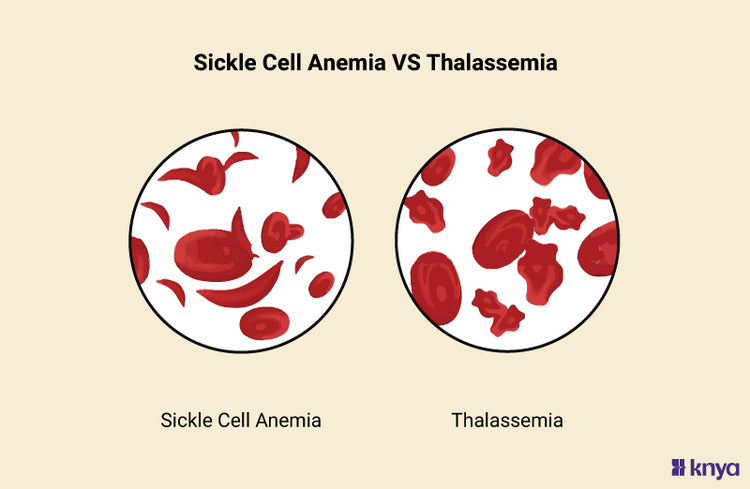 Difference Between Sickle Cell Anemia and Thalassemia – Knya