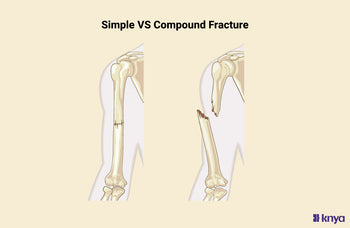Simple Vs Compound Fracture: Know the difference – Knya