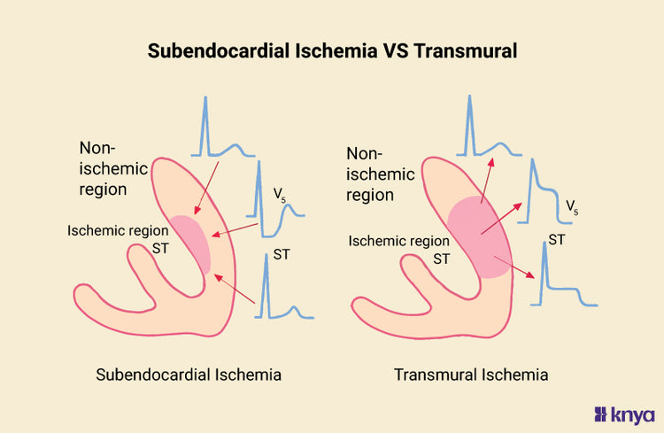 Subendocardial Ischemia and Transmural Ischemia, Ischemia, Myocardial ...
