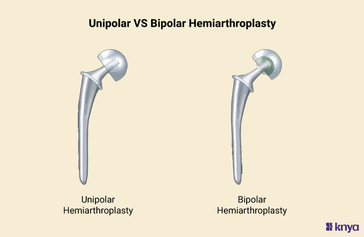 Unipolar vs. Bipolar Hemiarthroplasty: Understanding the Differences – Knya