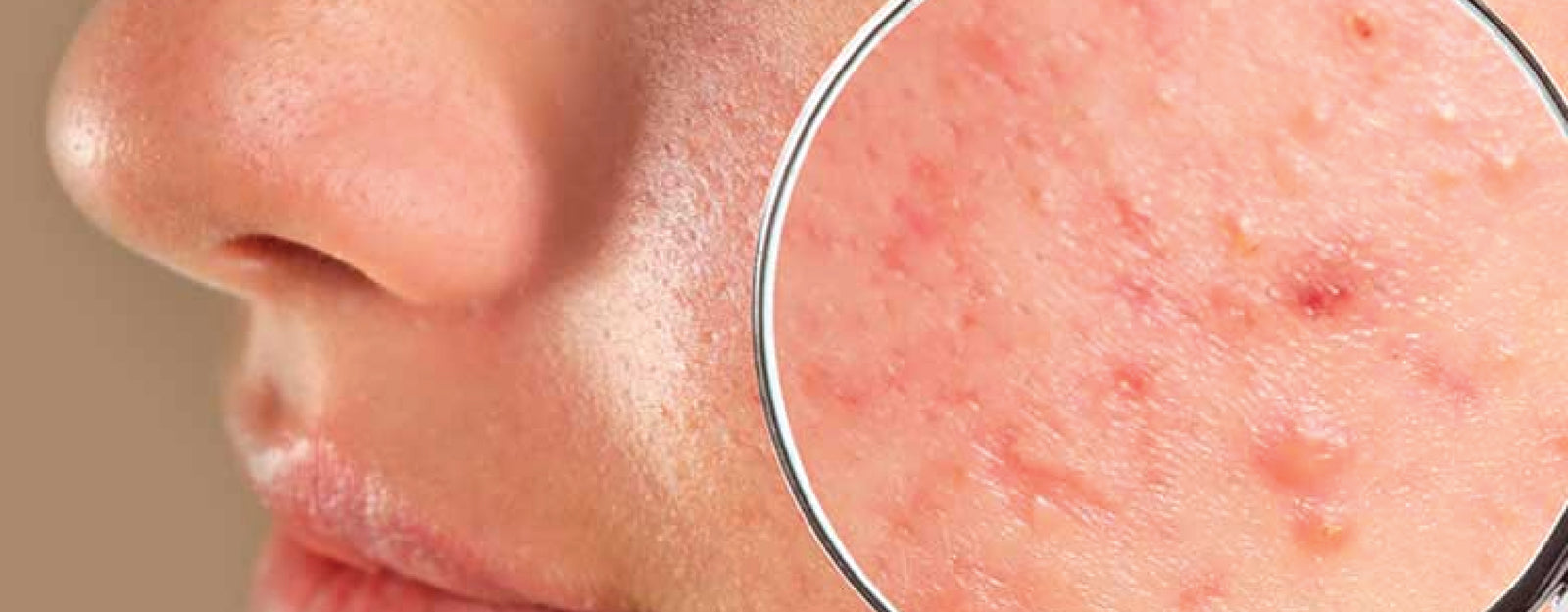 Meta Title Fungal Acne Vs Closed Comedones Know The Differences Knya