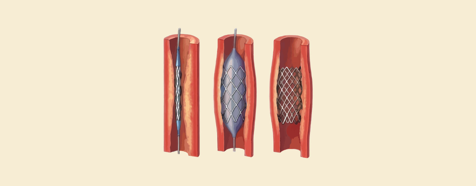 Difference Between Angiography and Angioplasty – Knya Difference Between Angiography and Angioplasty – Knya
