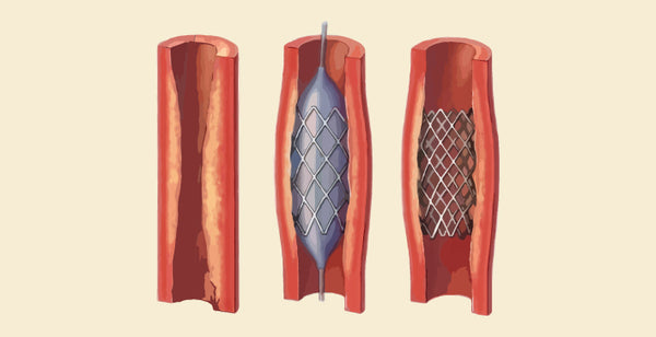 Understanding The Difference Between Balloon Angioplasty And Stent Insertion Knya